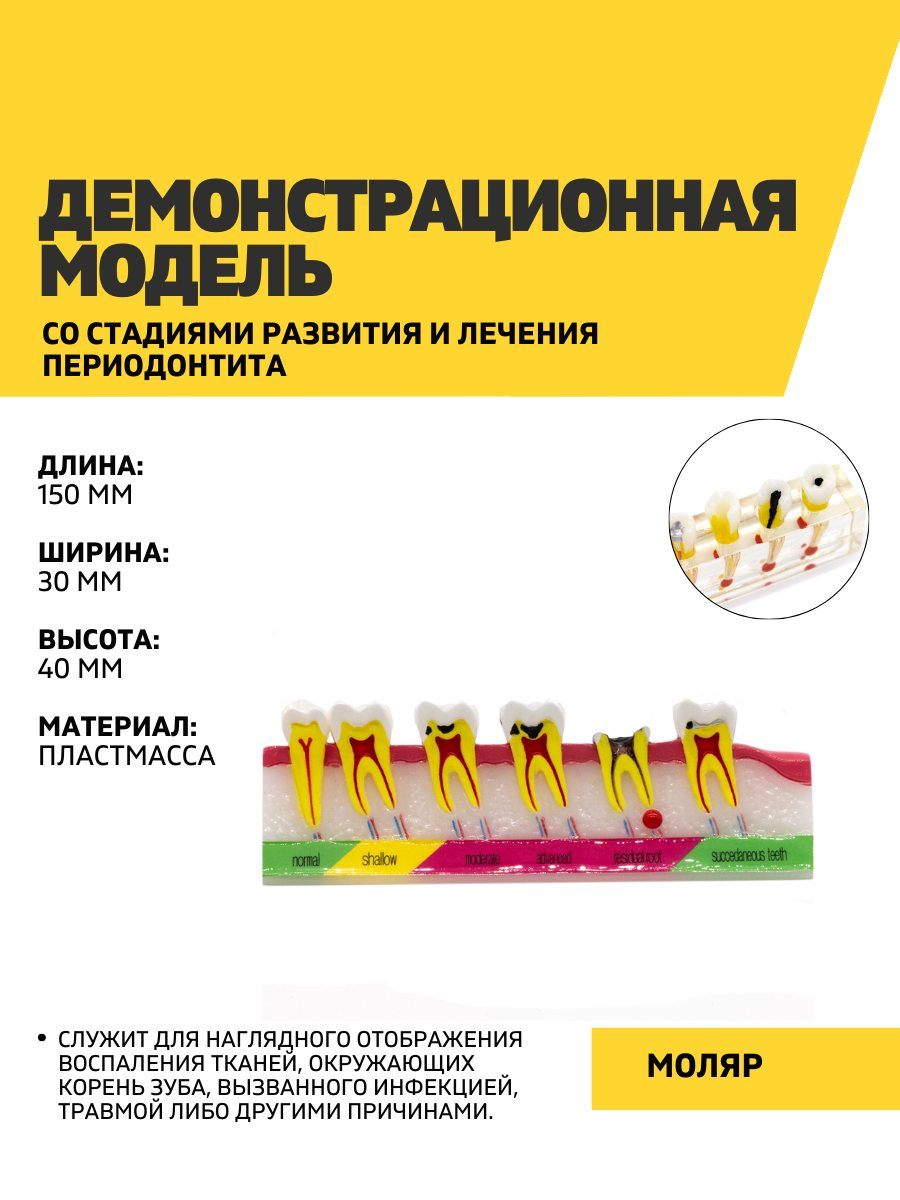 Демонстрационная модель со стадиями развития и лечения периодонтита моляра