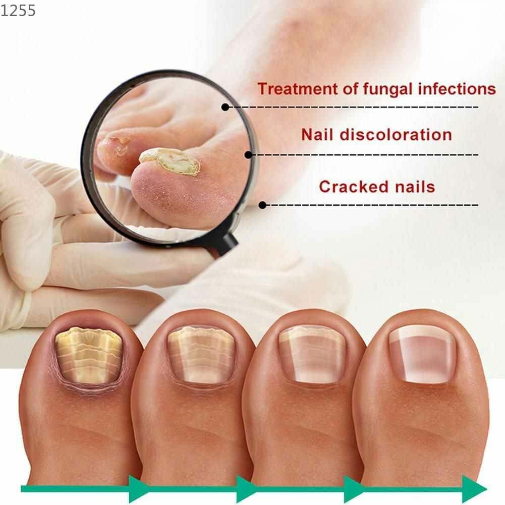 Лечение онихомикоза жидкость, Уход за ногтями на ногах, Подходит для лечения пожелтения, утолщения, вросших ногтей и т. д.