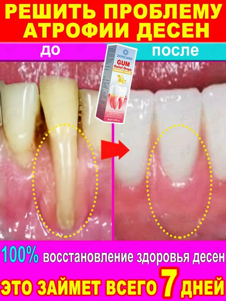 Используется для лечения пародонтита, стоматита, снятия чувствительности и отека десен, восстановления, профилактики и укрепления поврежденных десен, Гигиена полости рта.30 мл.