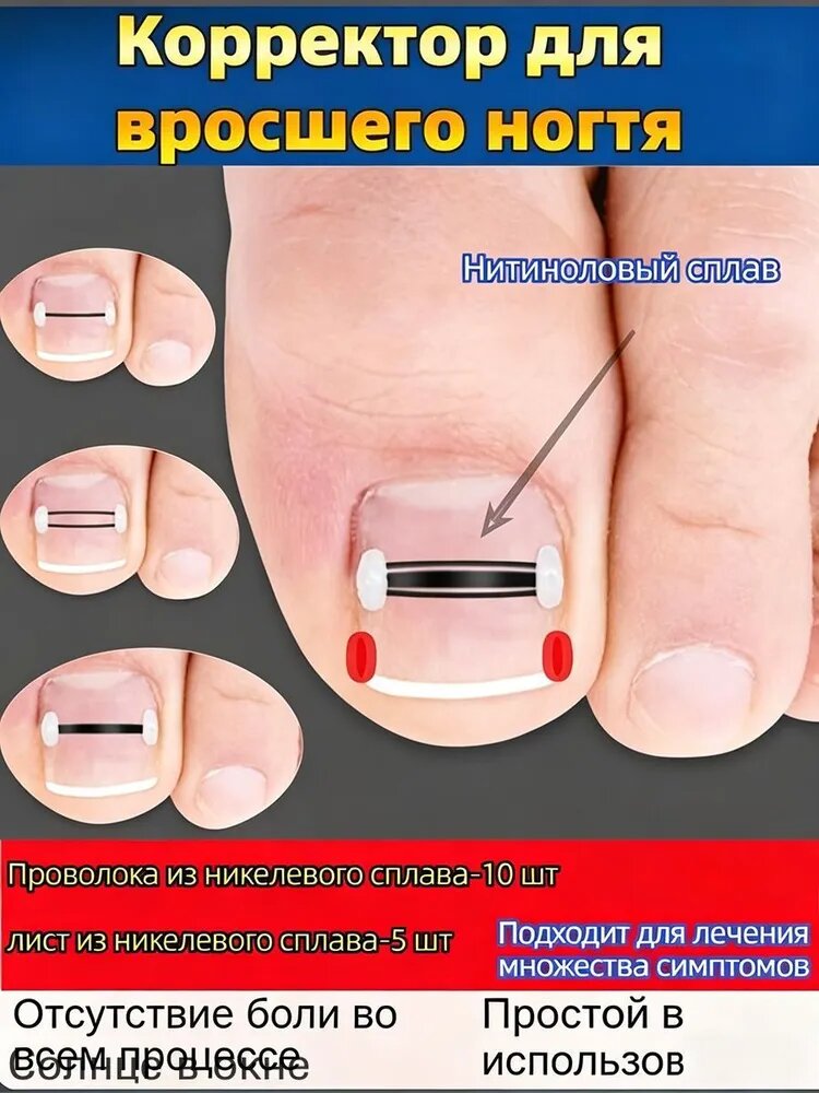 Комплект из 10+5 никелид-титановых корректоров для вросших ногтей