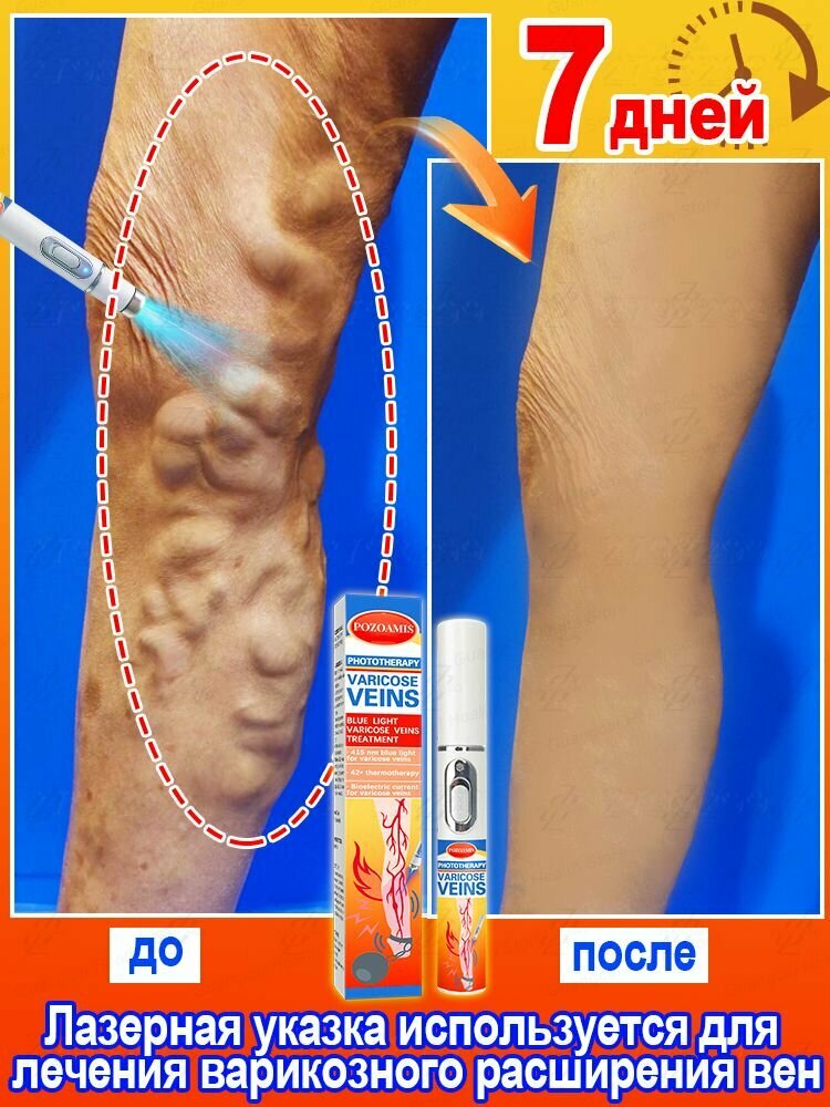 Лечение варикозного расширения вен лазерной указкой, снятие отечности ног, тяжести и отека, тромбоза, улучшение микроциркуляции, эффективное лечение сосудистых звездочек