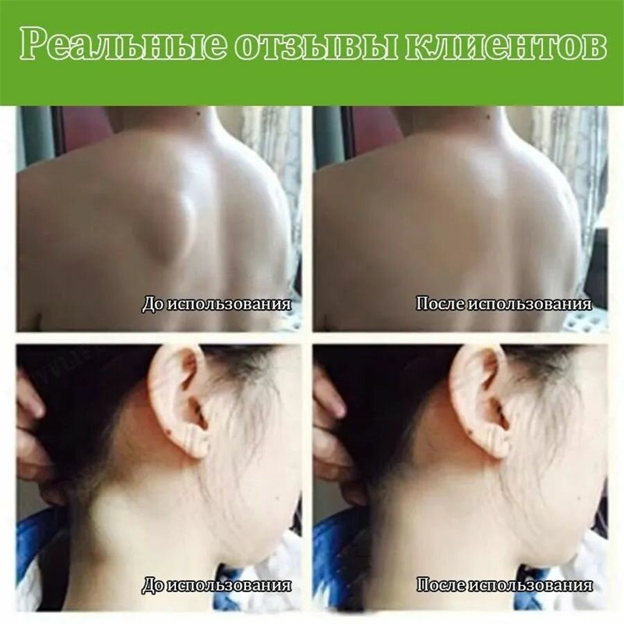 2 шт*20г Липома удаляет крем, для устранения жировых отложений и подкожных шишек, показан при отечности кожи, фиброзном жировике, 20 г