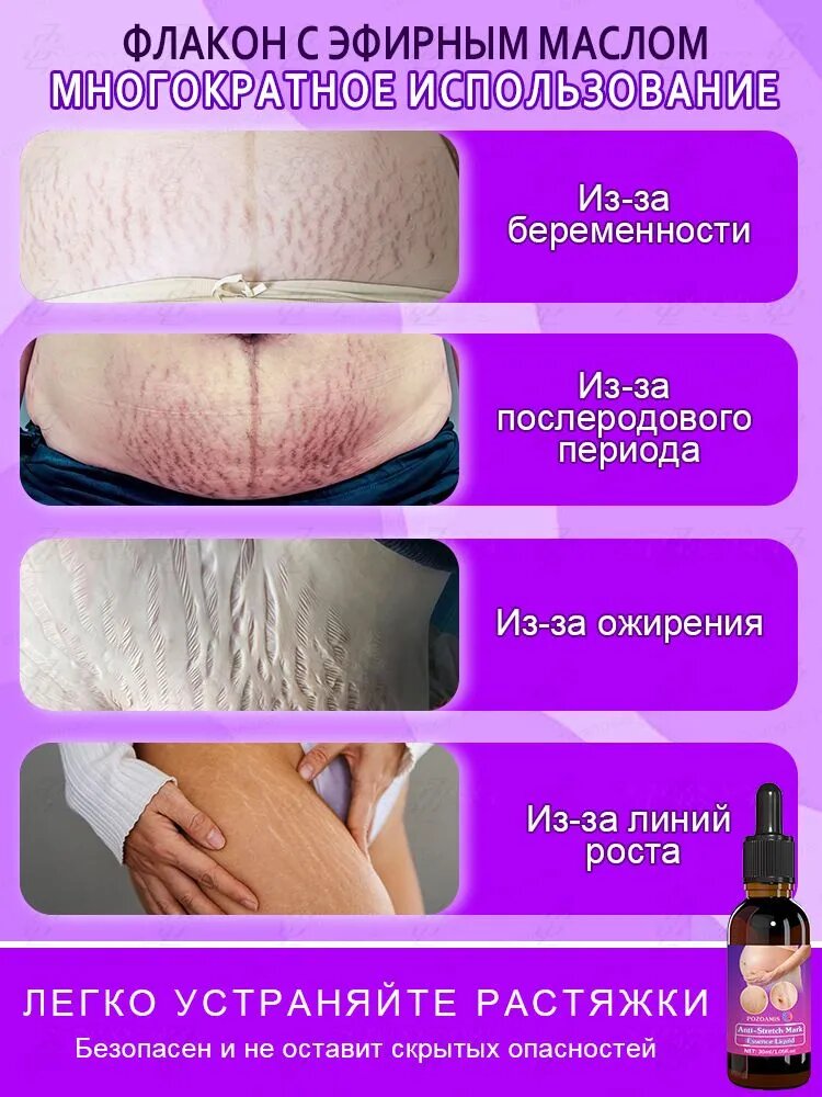 Масло для лечения растяжек. Специально разработано для беременных женщин и людей с избыточным весом. Устраняет жировые отложения, осветляет растяжки, питает кожу и борется с целлюлитом. 90 мл.