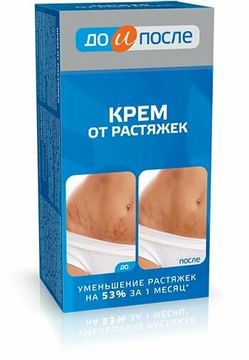 До и после крем от Растяжек