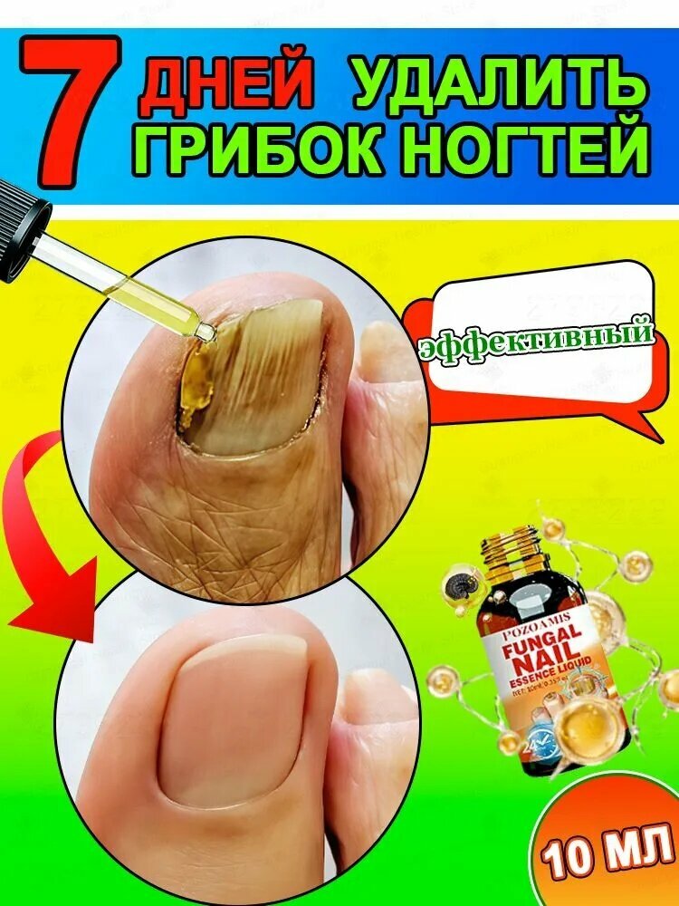 Масло от онихомикоза, подходит для лечения грибковых инфекций ногтей на ногах и онихолизиса, снимает зуд, питает кутикулу ногтя, способствует росту и укреплению ногтей, 100 мл.