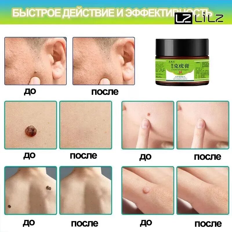 Лечебное средство для удаления бородавок, крем Caobenkeyouyao, 20 г, для всех типов кожи — фото 1