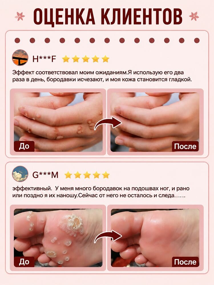 Быстродействующий крем для удаления бородавок, безболезненно удаляет бородавки, родинки и папилломы, не оставляя шрамов. удаление родинок удаление папиллом безболезненно