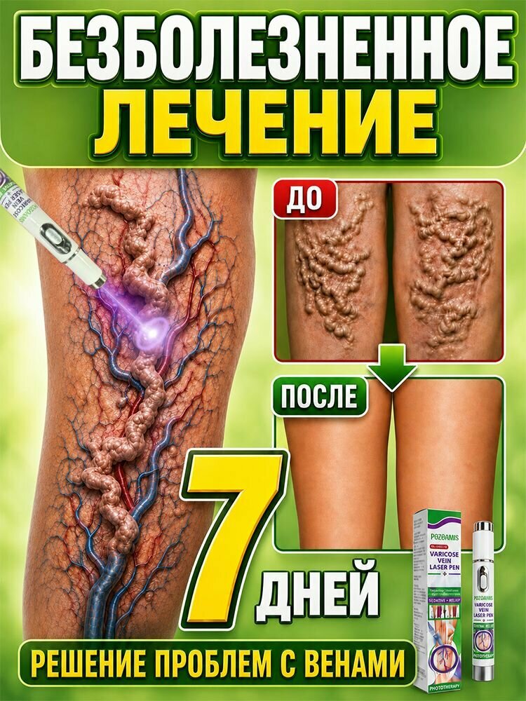 Лазерный аппарат от варикоза, быстро снимает отёки, боль и тяжесть в ногах, помогает убрать сосудистые сетки, звёздочки и расширенные вены, для домашнего ухода за ногами и венами, 1 шт домашний лазер для вен при варикозе снятие отеков