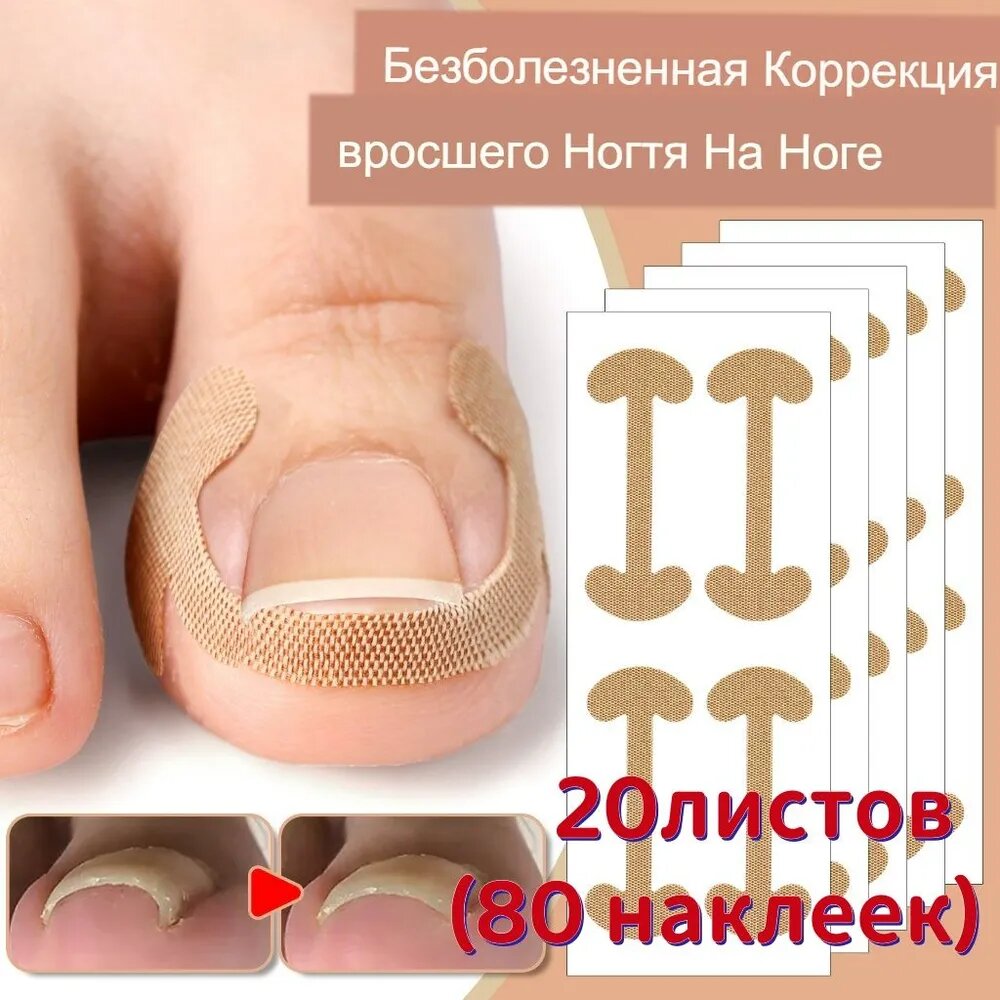 Наклейка пластырь, корректор от вросшего ногтя против врастания ногтевой пластины,20 листов (80 наклеек)