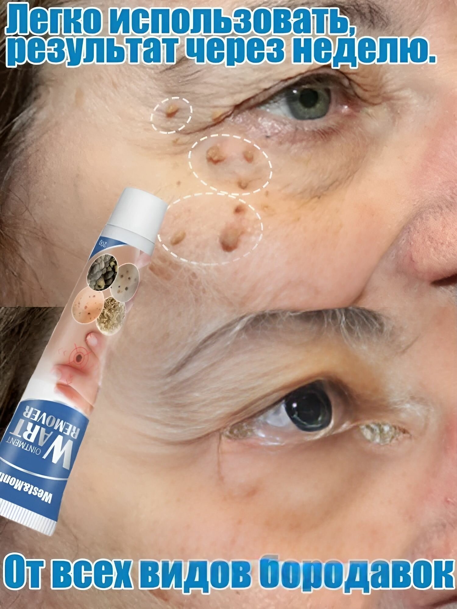 / Мазь от бородавок, Крем средство для удаления бородавок, папиллом и родинок, безболезненно, не оставляет следов без побочных эффектов / 20г