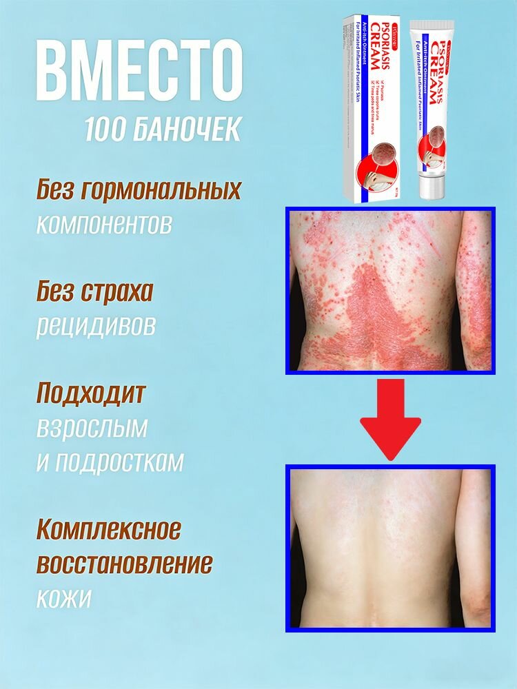 Этот крем от псориаза содержит натуральные ингредиенты и подходит для лечения экземы, псориаза, ухода за лицом, лихена, дерматита и зуда. 20 мл