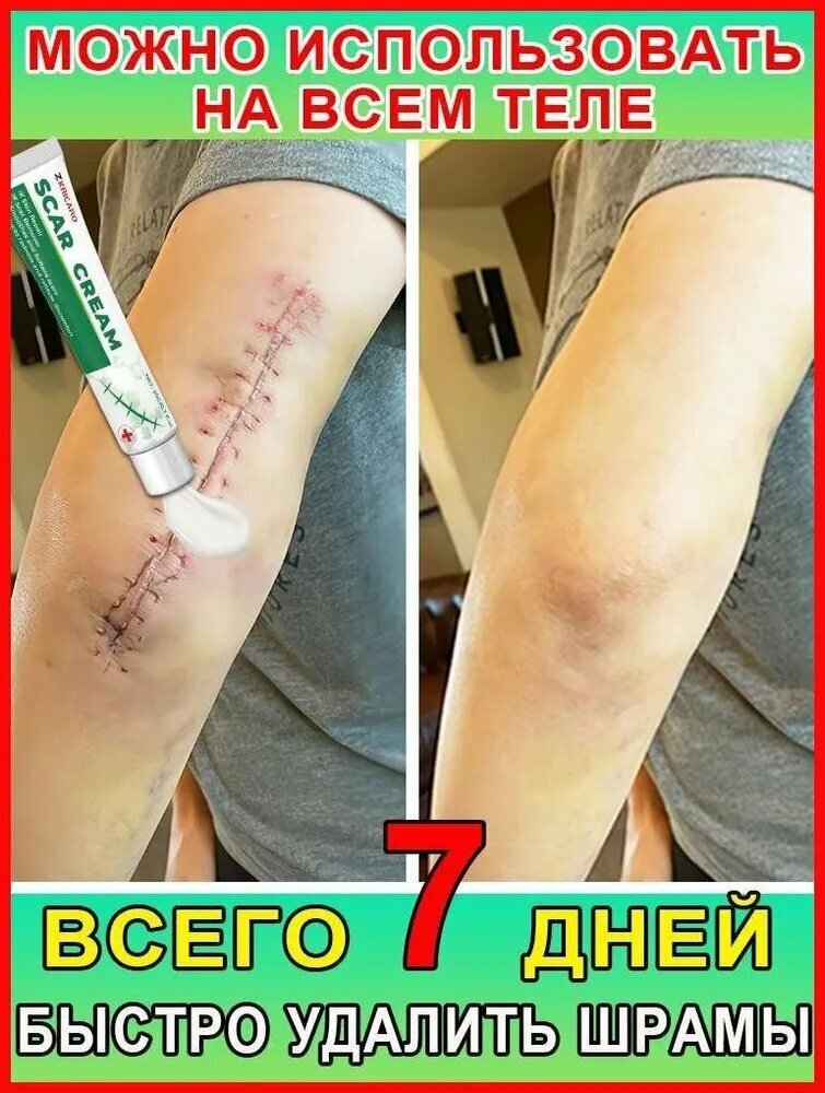 Крем для удаления шрамов. Быстро удаляет шрамы, растяжки, ожоги, следы от прыщей, отеки после ран и пигментацию. Подходит любой части тела. 30 мл