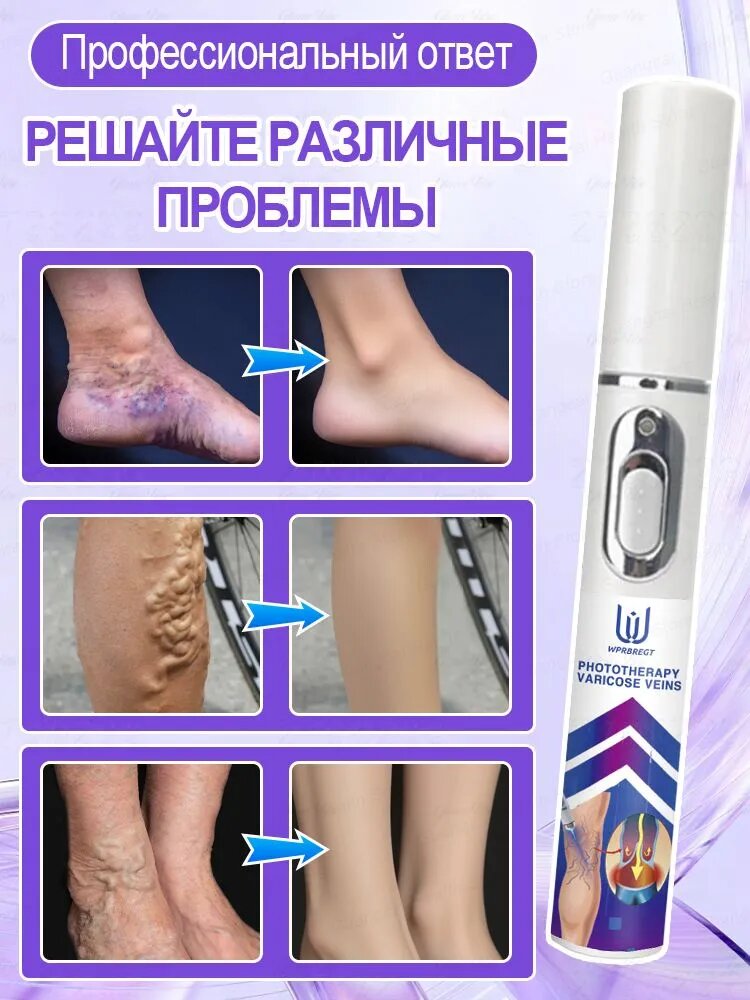 Лазерное лечение варикозного расширения вен. Снимет усталость ног. Эффективно и быстро устраняет сосудистые звездочки, тромбы и отеки ног. Нежный и не вызывающий раздражения, не оставляющий шрамов.
