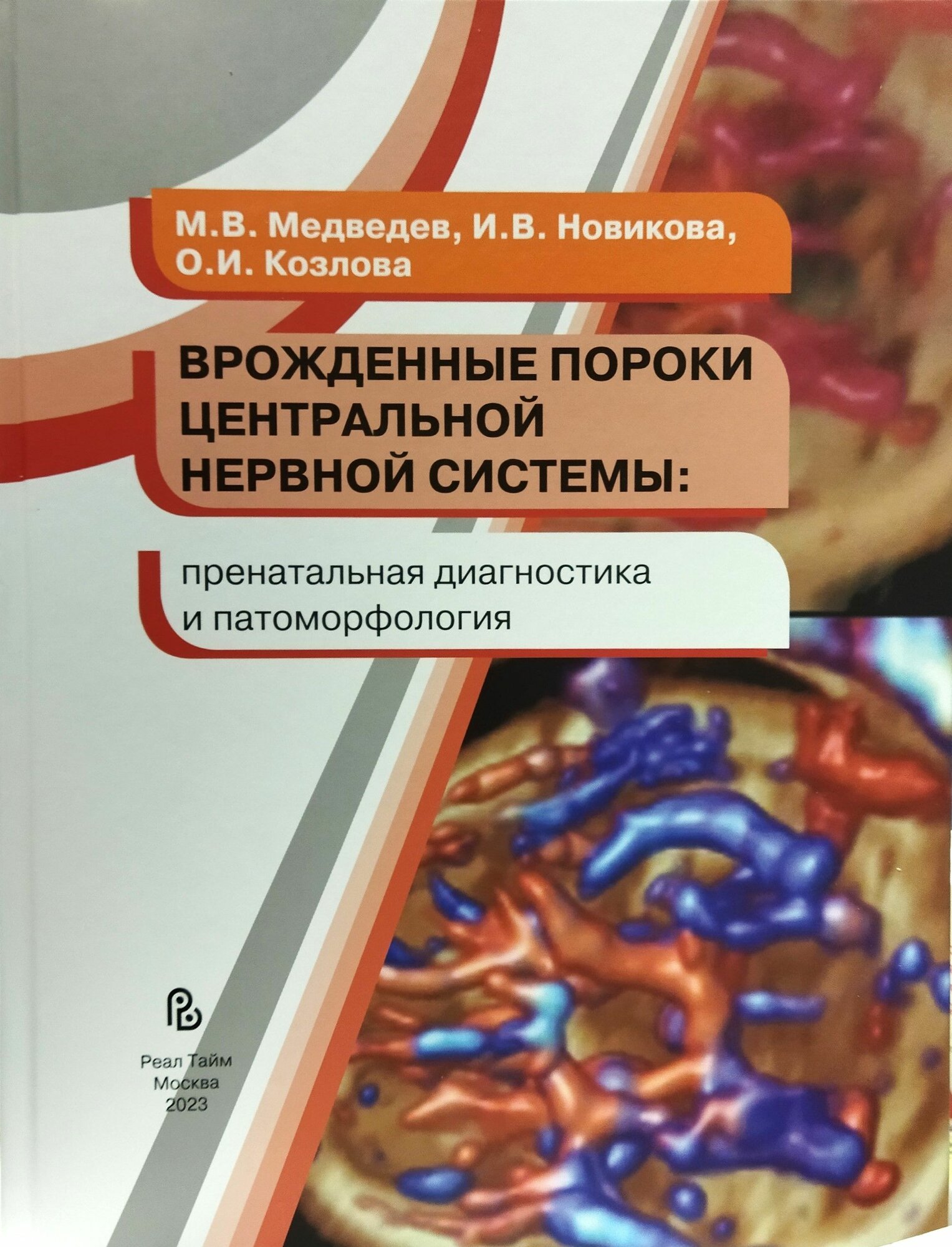 Врожденные пороки центральной нервной системы. 2023г.