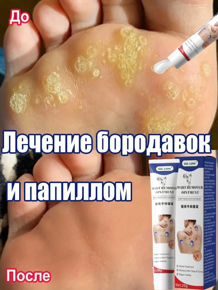 Мазь от бородавок, Крем средство для удаления бородавок, папиллом и родинок, безболезненно, не оставляет следов без побочных эффектов .20г.