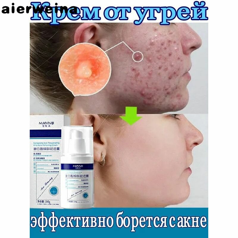 Крем для лица от прыщей 100 г антиакне средство для проблемной и жирной кожи против воспалений, угрей и чёрных точек