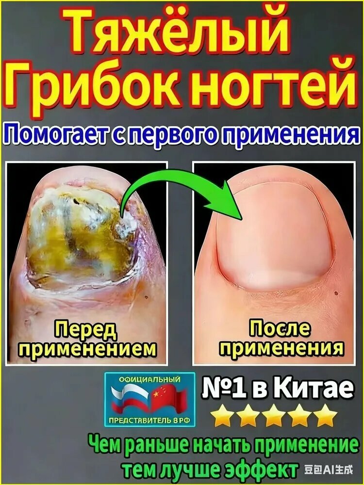 Мазь ноготок от грибка ногтей на ногах, Лечите грибковые инфекции, укрепляйте и восстанавливайте ногти и роговой слой кожи, а также устраняйте грибок ногтей на ногах.