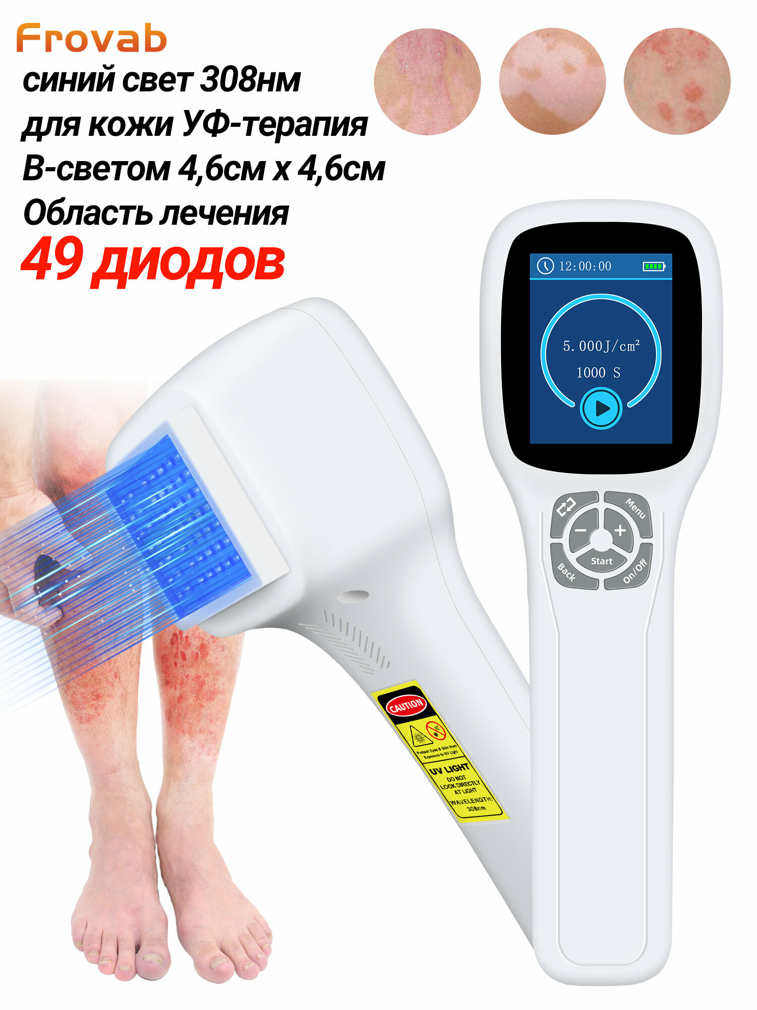 Аппарат УФ Frovab 308нм 49 диода, регулировка дозы, лечение витилиго, псориаза и кожных воспалений дома