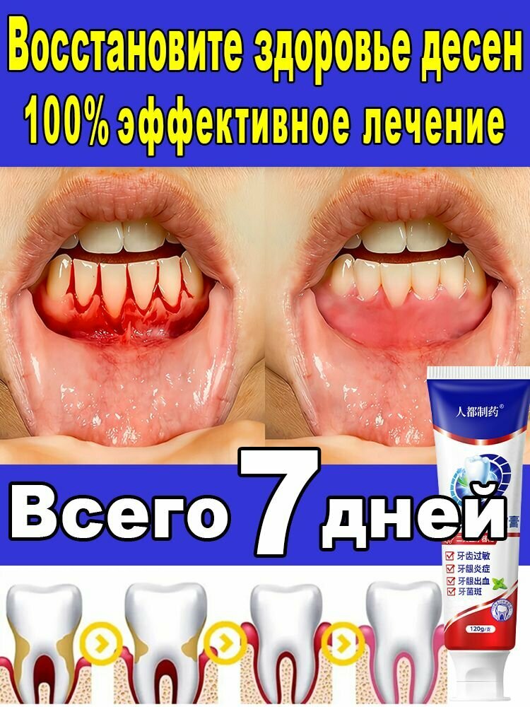 Зубная паста для укрепления десен от пародонтита, стоматита, кровоточивости, снятие отека и чувствительности, 120 г