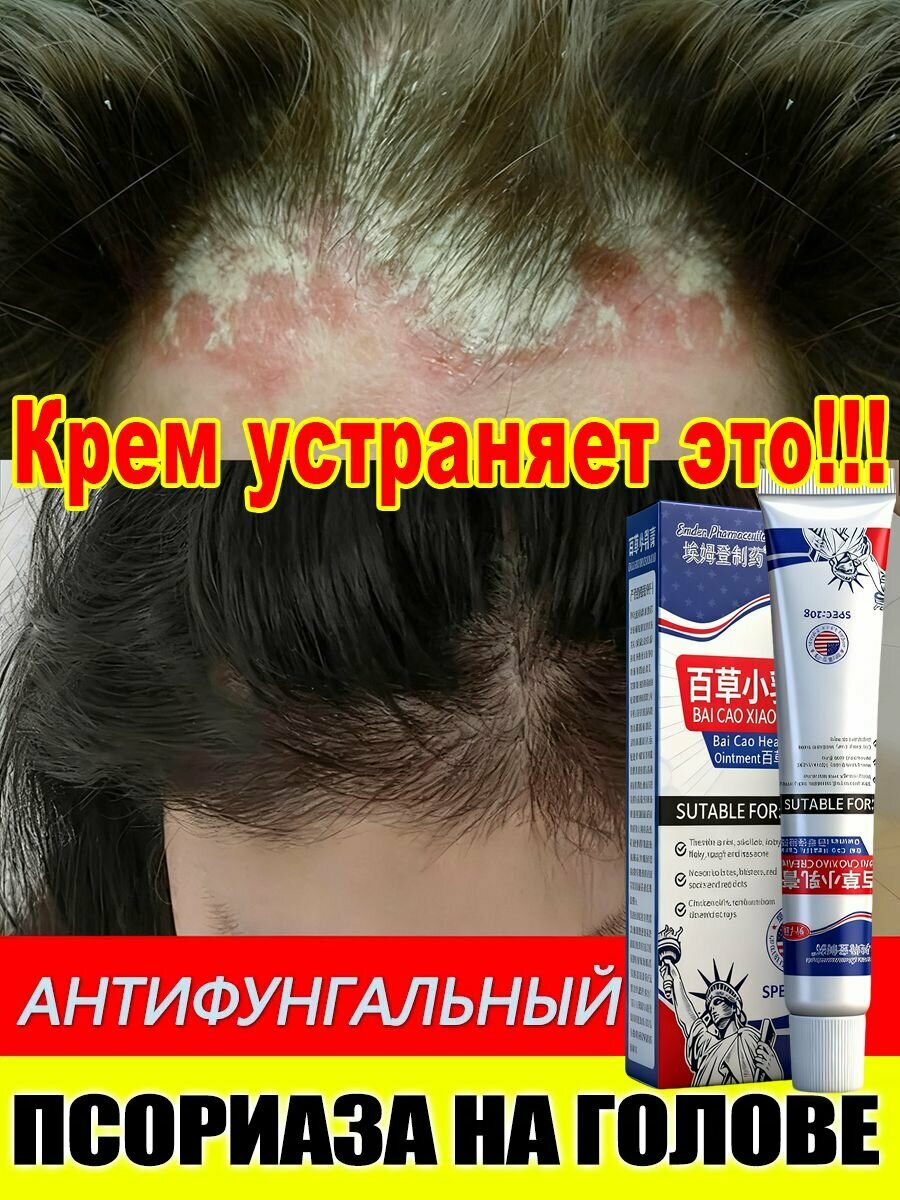 Крем от псориазадля лечения себорейного дерматита, зуда кожи и других кожных заболеваний, для кожи головы, тела и лица, 20 г
