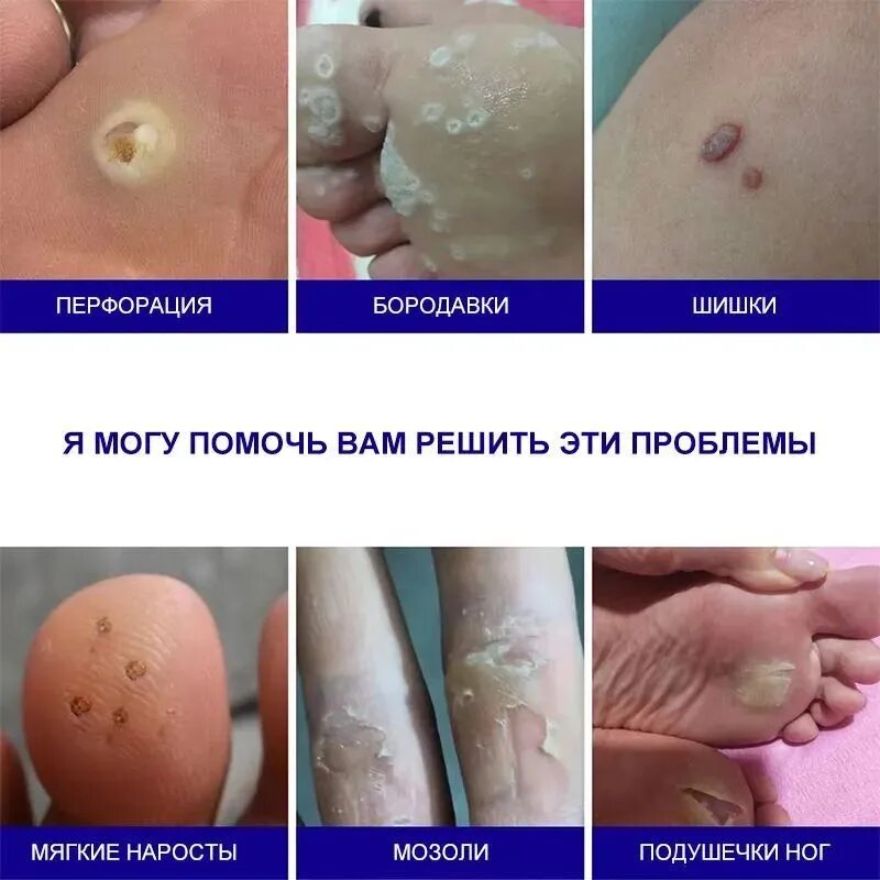 Крем гель от папиллом, чистотел, средство от бородавок. Натуральные растительные ингредиенты,20 гм