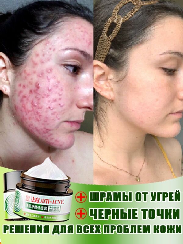 Салициловая мазь от прыщей, эффективно борется с воспалениями, направленная на акне и угри, прыщами и последствиями акне, подходит подросткам и проблемной коже, 30 г.