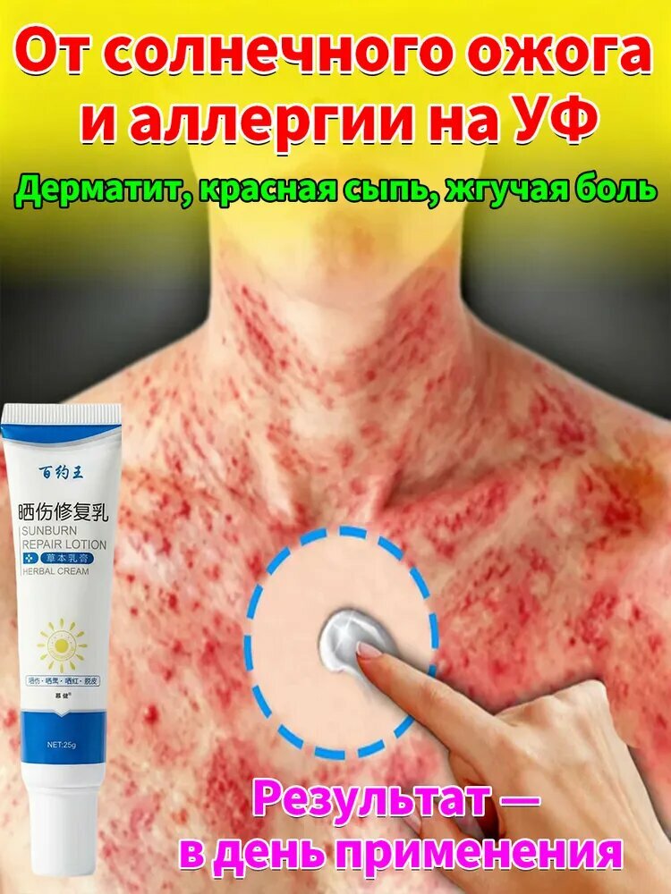 Крем от солнечного дерматита и УФ-аллергии
