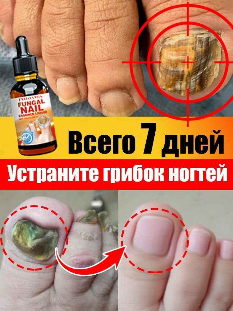 Эфирные масла, используемые для лечения онихомикоза. Лечат онихомикоз, применяют противогрибковые препараты, устраняют паронихит, восстанавливают ногти и улучшают их здоровье.10ml