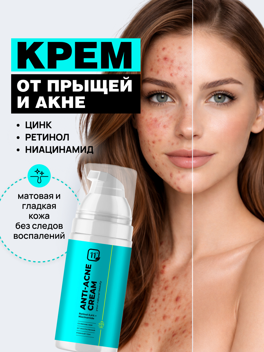 Крем от прыщей и акне для лица, с ретинолом 0,4% и ниацинамидом