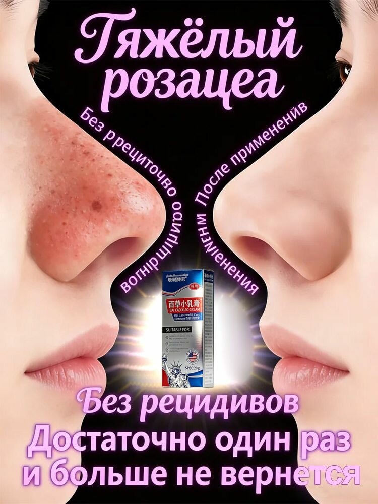 Крем от розацеаисцеление красный нос и прыщи