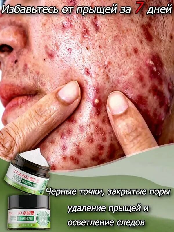 Крем от прыщей для подростков с проблемной кожей 30 г