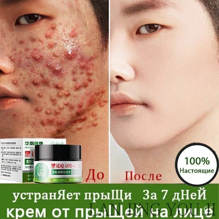 Крем для лица от прыщей от черных точек и угрей, жирной и чувствительной кожи, Снять воспаление на лице для подростков и взрослых 30г