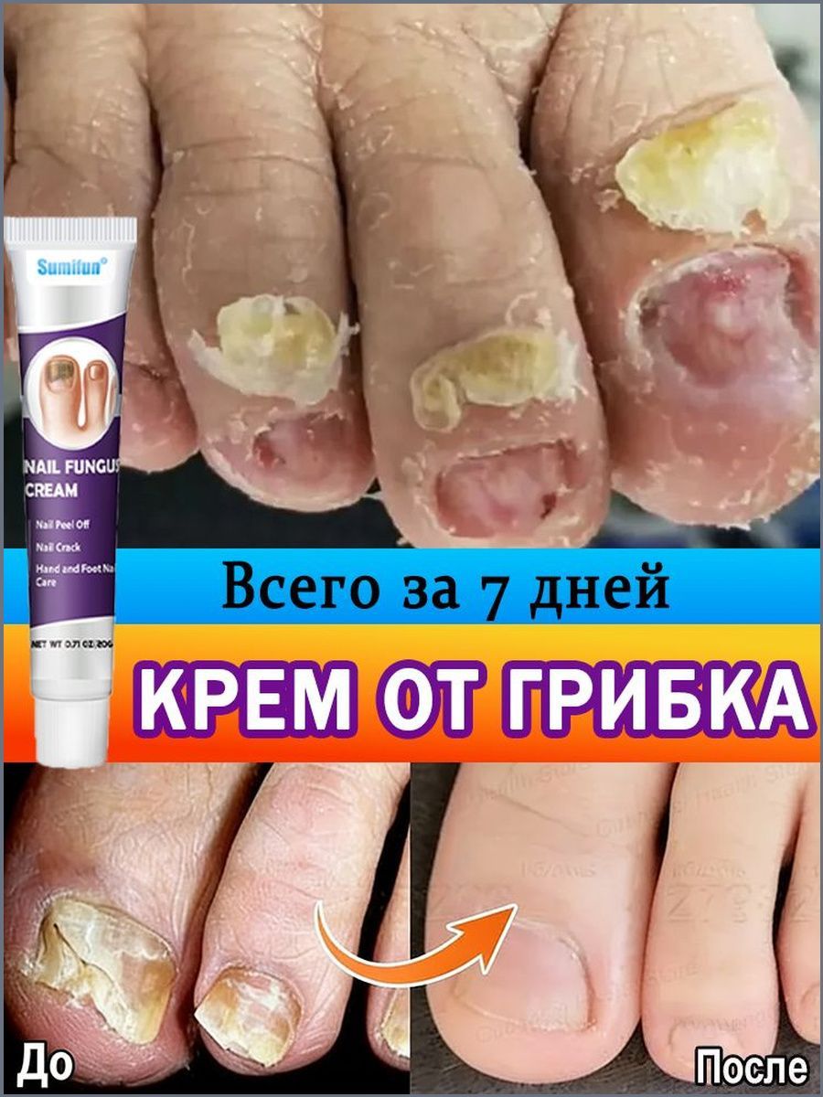 Средство от грибка ногтей на ногах. Уход за ногтями, борьба с несовершенствами. Ланбена противогрибковое новое обновленное средство