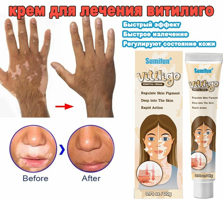 Антибактериальный крем от Витилиго против пигментации, Белые пятна, витилиго, веснушки, пятна от пота, коричневые пятна