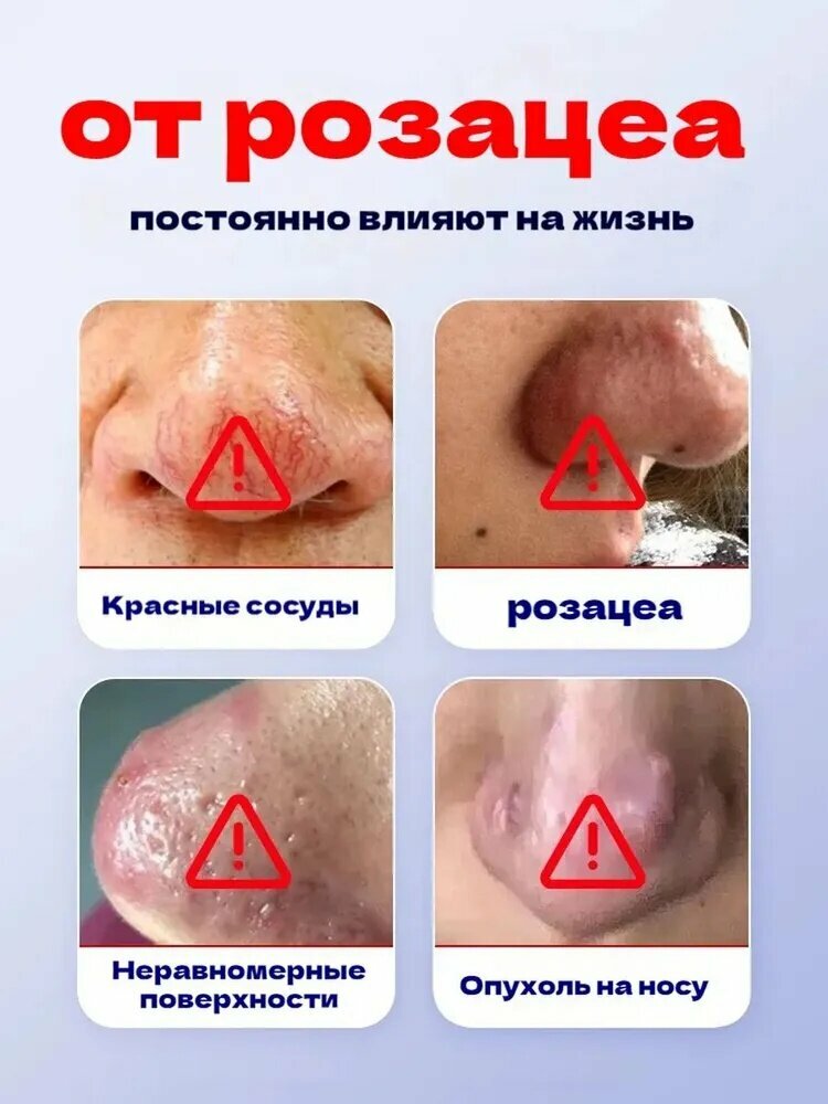 Крем от купероза для лица покраснений на лице и розацеа, Куперофаг Крем от купероза на лице, антикупероз, средство от сосудистых звездочек, от покраснений, розацеа, Китайская чудо-мазь.20 г