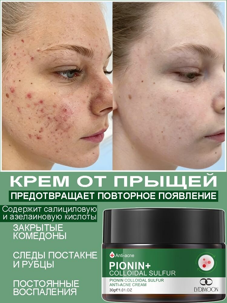 LYDIMOON крем от прыщей профессиональная, борется с прыщами и воспалениями, вызванными акне, 30 г