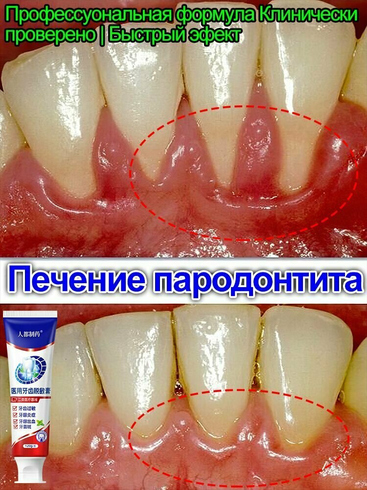 Используется для лечения пародонтита, стоматита, Кровоточивость и боль в деснах, неприятный запах изо рта и обоняние Восстановить здоровье зубов/30 мл.