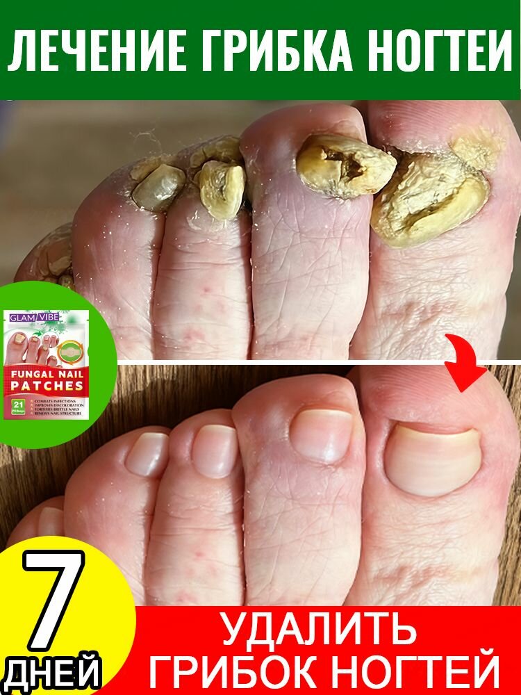 Пластыри от грибка ногтей быстро избавляют от грибковых инфекций рук и ног, а также вылечить утолщение ногтей, покраснение, отек, зуд, расслоение 21шт