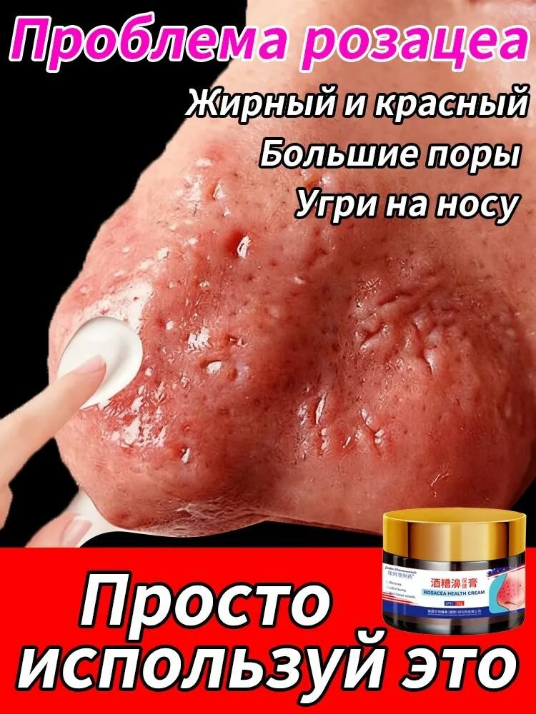 Гельтек Гель Демотен от прыщей акне демодекоза розацеа для проблемной и жирной кожи лица 50мл