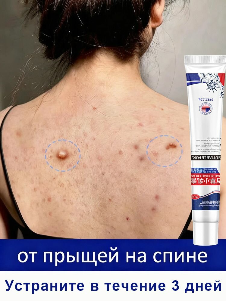 Мазь от угревой сыпи/Мазь фолликулита на спине, используется для лечения угревой сыпи и воспалительных высыпаний, для ухода за кожей, 20 мл
