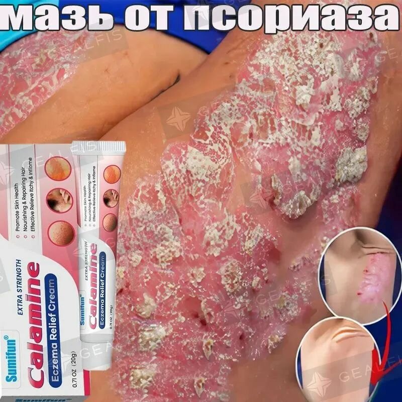 Мазь от псориаза, экземе и герпесе, акне, ожогах, порезах, от прыщей на лице, 20 г