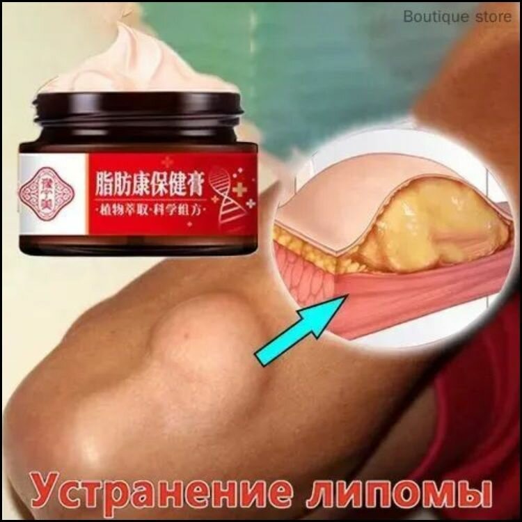 Мазь от липом и жировиков, быстро удаляет подкожные жировые опухоли, натуральный китайский, травяной крем для удаления целлюлита устранения, 30 г