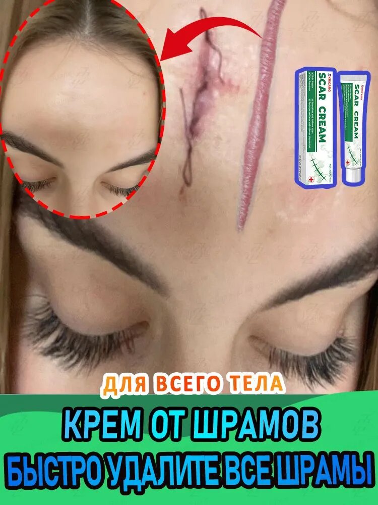Крем для удаления шрамов. Быстро удаляет шрамы, растяжки, следы от акне и ожогов. Мягкий и не раздражающий, подходит как мужчинам, так и женщинам. 20 мл