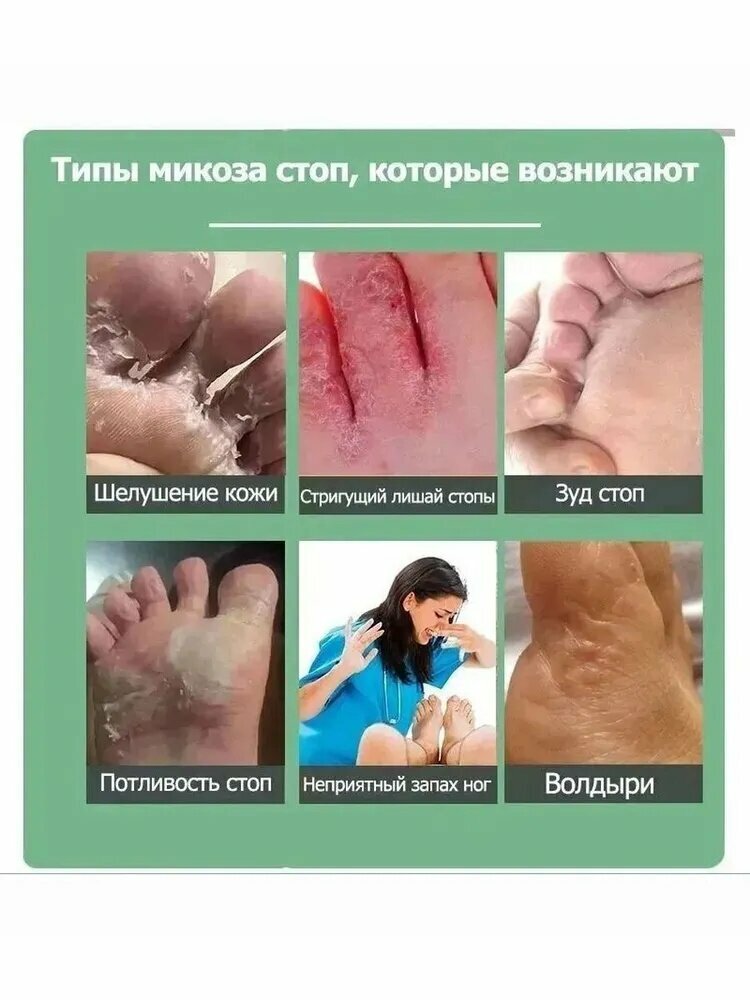 Крем от шелушения между пальцами ног антигрибковый, натуральный состав