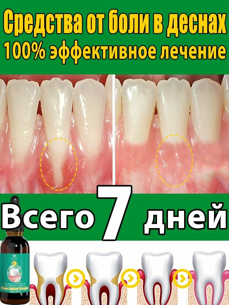 Используется для лечения пародонтита, стоматита, снятия чувствительности и отека десен, восстановления, профилактики и укрепления поврежденных десен, Гигиена полости рта, 30 мл, 1 флакон