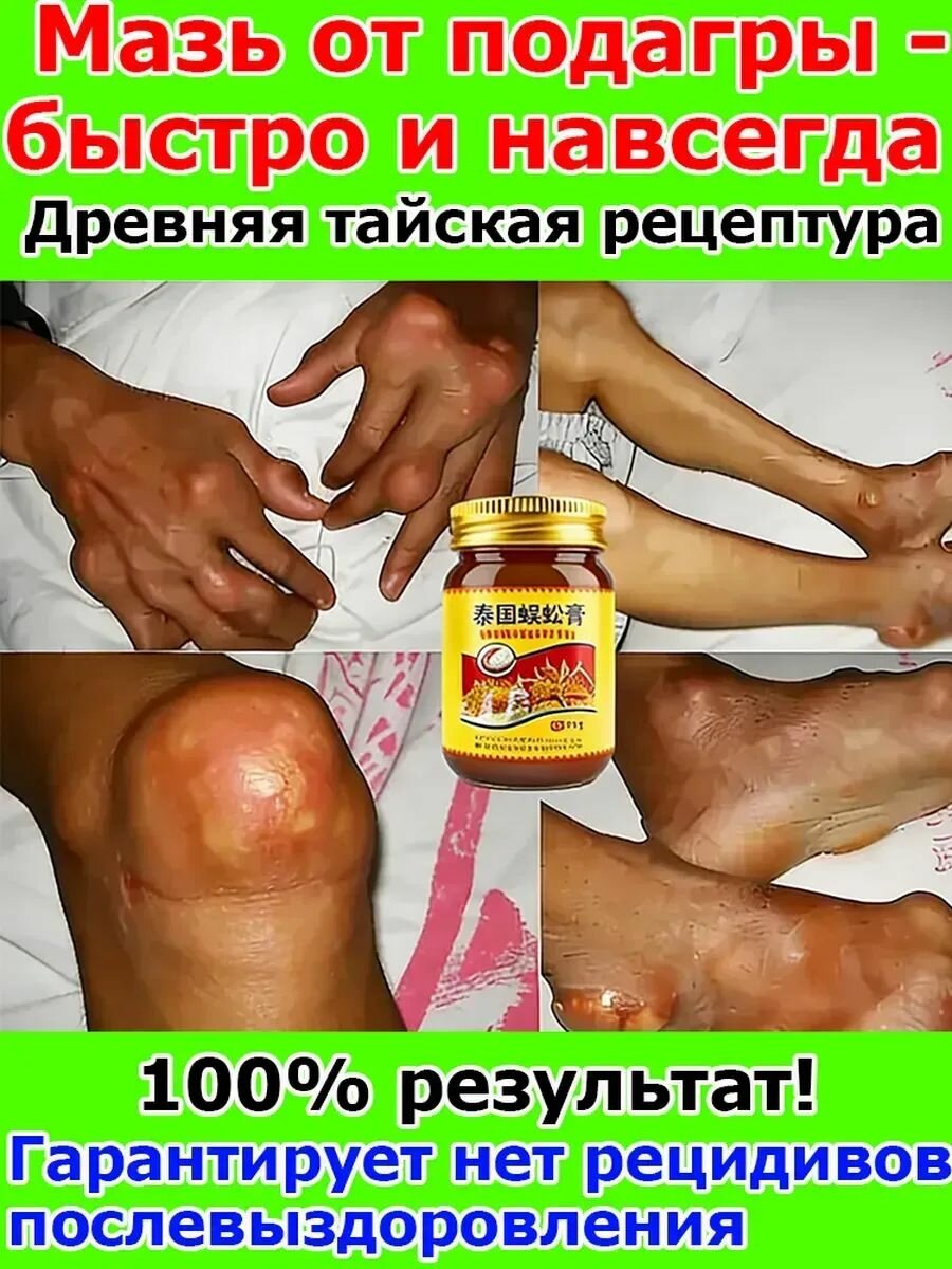 Мазь от подагры на ноге и для рук и артрита