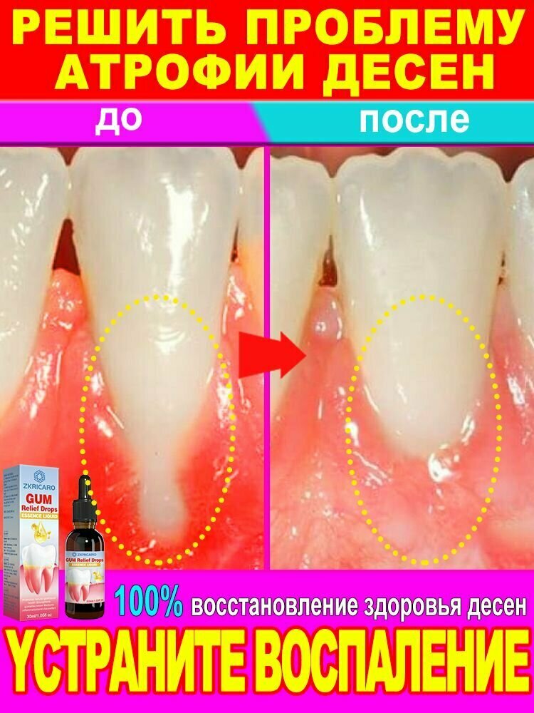 Используется для лечения пародонтита, стоматита, снятия чувствительности и отека десен, восстановления, профилактики и укрепления поврежденных десен, Гигиена полости рта.30 мл.