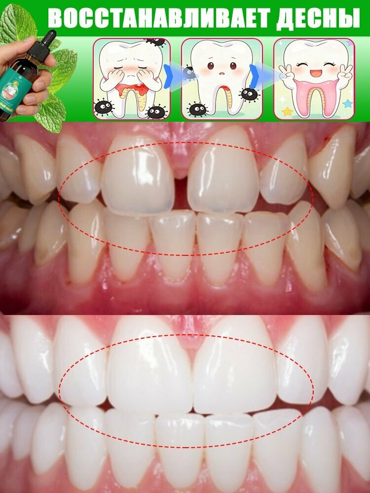 Масло для ухода за полостью рта. Быстро облегчает симптомы пародонтита, рецессии десен и отеков предотвращает кариес и защищает десны, поддерживая здоровье полости рта. 30 мл