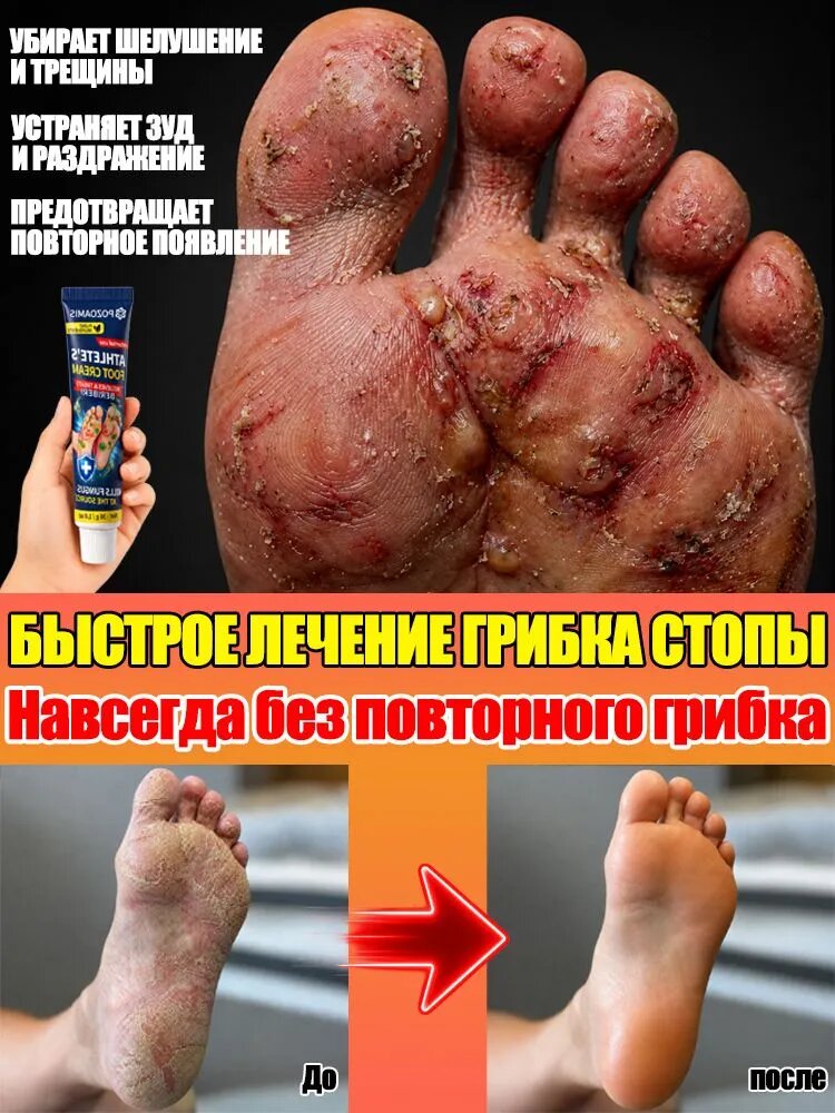 Крем от грибка стоп, трещин и зуда, против покраснения, шелушения, псориаза и язв, антигрибковая мазь для лечения кожи ног, 30 г