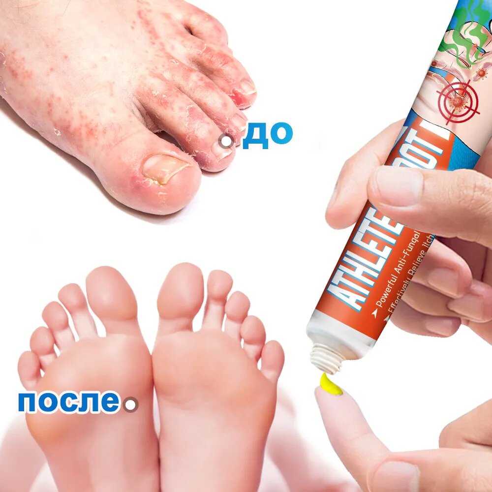 Средство от запаха ног для зуда и язв между пальцами, против грибка, дезодорант эффективное 20г
